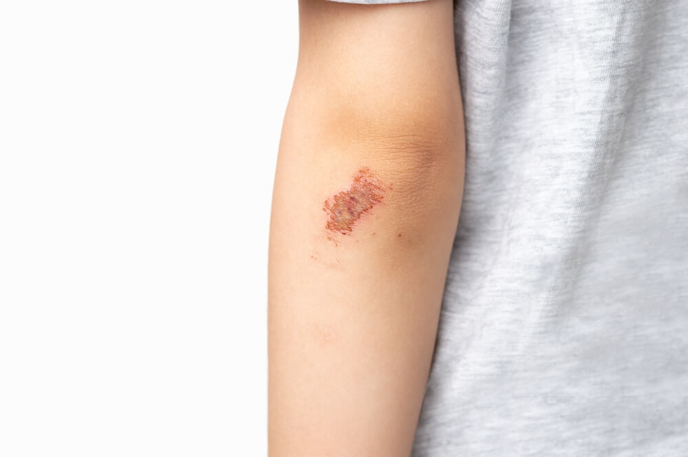 Child Burn Injuries: What You Need to Know | Free Consultation